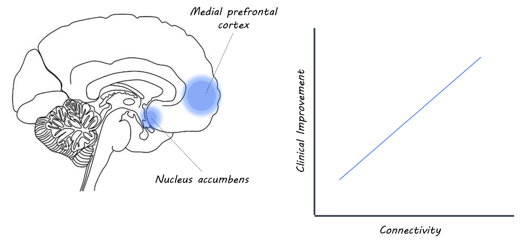 Using Brain Connectivity to Predict Treatment Response to Deep Brain Stimulation in OCD ...