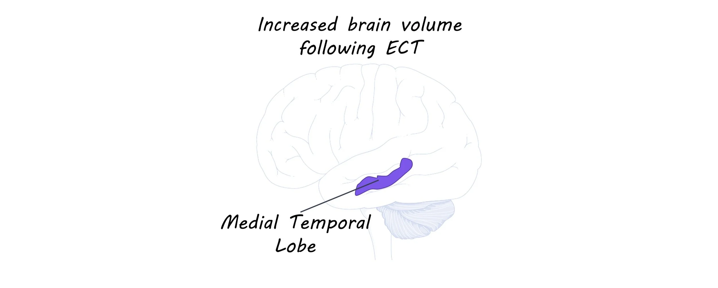 Ect Brain