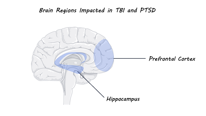 Overlapping Neural Circuitry of Traumatic Brain Injury and Trauma ...