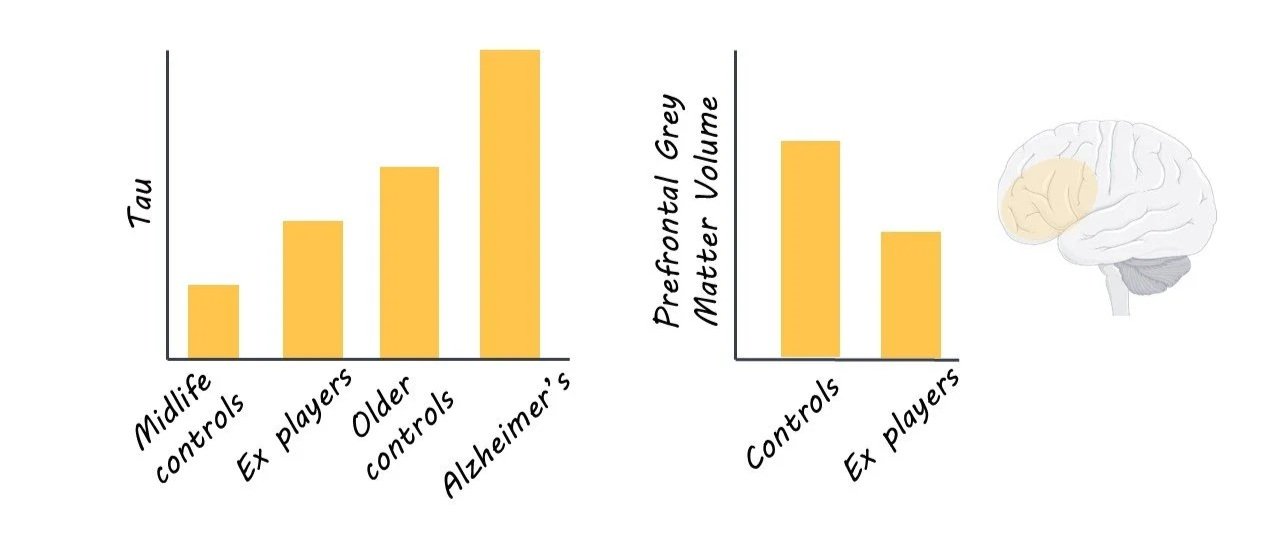 Rugby Players Show Signs of Neurodegeneration in the Brain — BrainPost ...