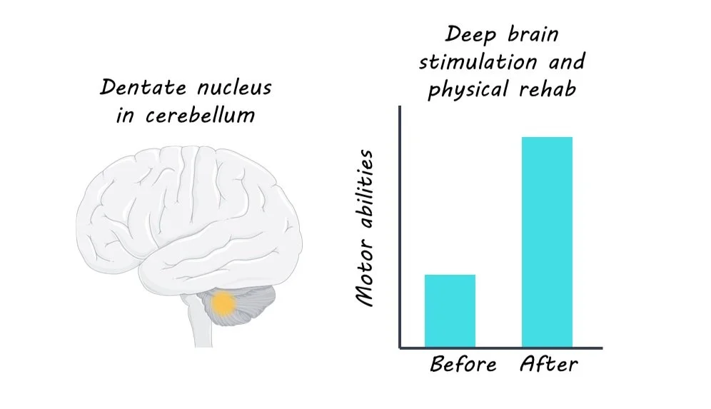 Deep Brain Stimulation Improves Motor Ability in Stroke Survivors — BrainPost | Easy-to-read ...