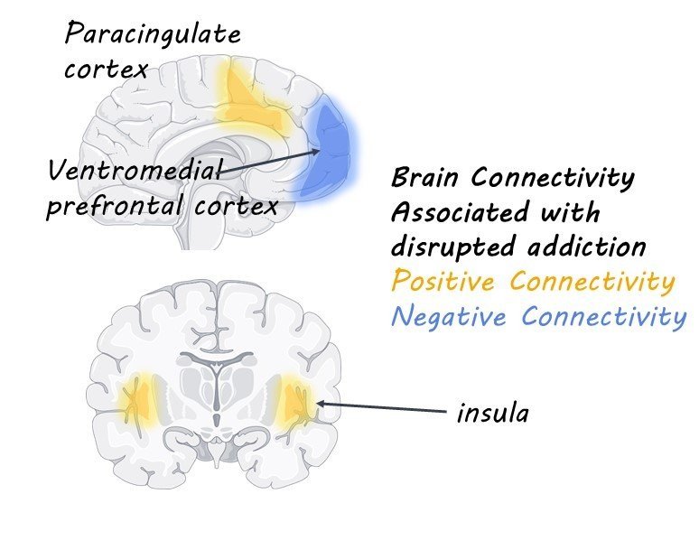 Using Brain Lesions to Identify a Common Addiction Brain Circuit ...