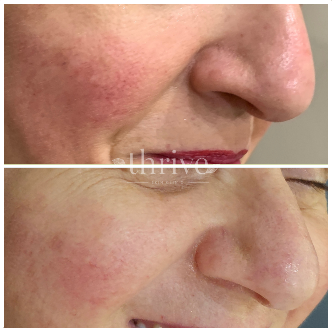 Laser Genesis Treatment- Medical Clinic Wollongong