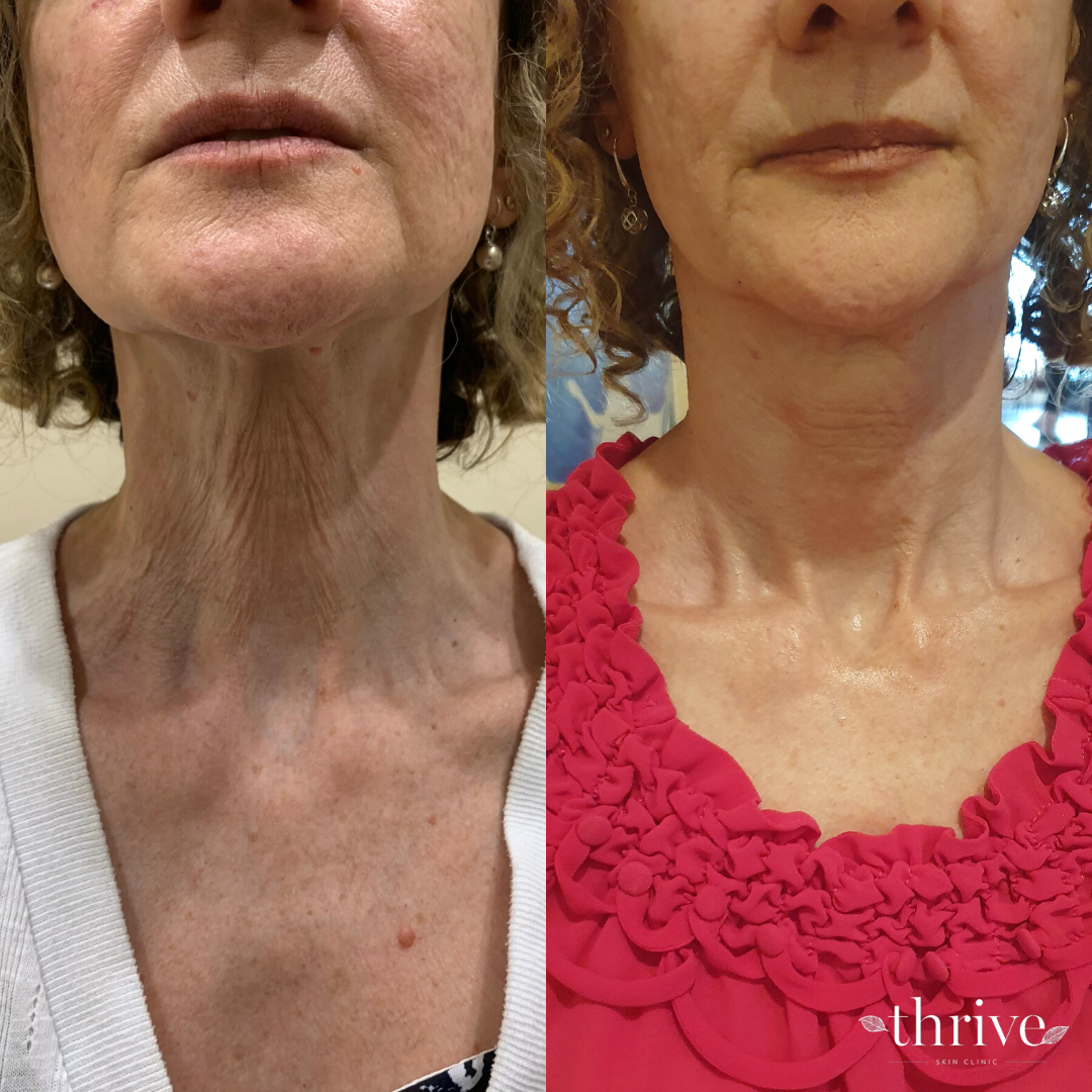 🔥 Tixel® - the best low downtime skin rejuvenation device to get your ...