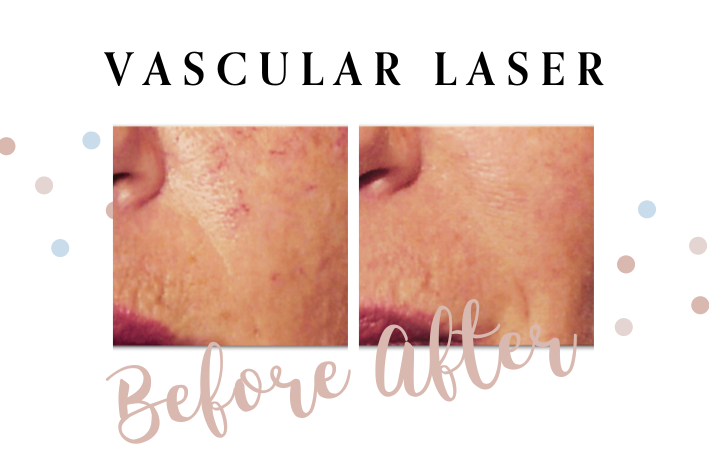 V-Beam Perfecta Laser Sydney | Facial Redness & Vascular Treatment – Dr ...