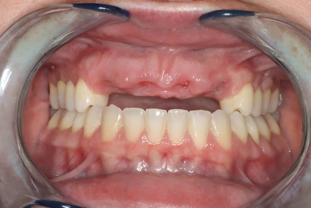 Implants — Utah Valley Periodontics & Dental Implants