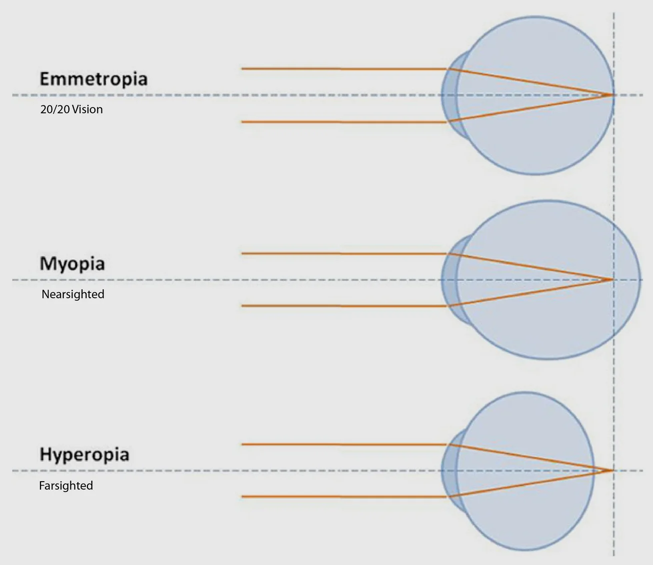 Refractive Error — The Brown Center
