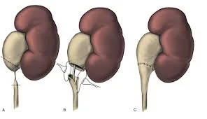 Robotic Pyeloplasty - For Obstructed Kidney — Fairbanks Urology