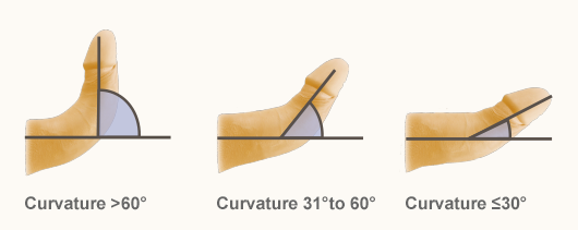 Peyronie's Disease VS Normal Curvature — Fairbanks Urology