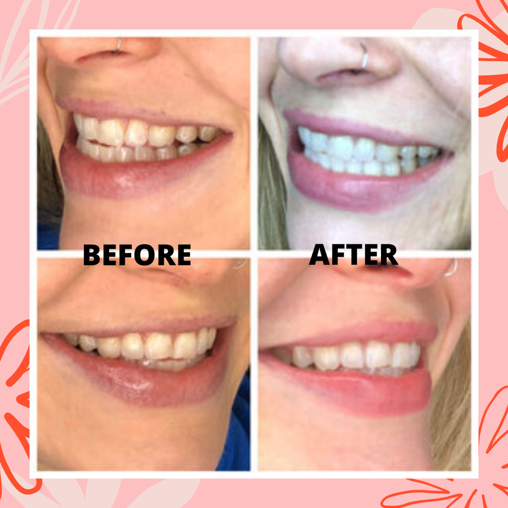 My First Teeth Whitening Experience: Smile Brilliant Results ...