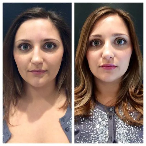 1 Syringe Of Juvederm In Lips Before And After | Lipstutorial.org
