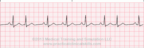 Matters of the Heart - Junctional Rhythms and Beats — PatMac,RN