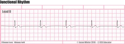 Matters of the Heart - Junctional Rhythms and Beats — PatMac,RN