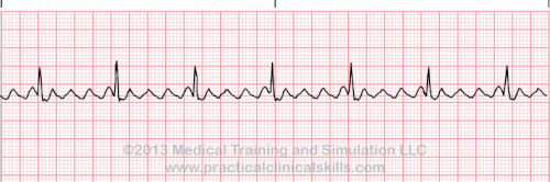 Atrial Fibrillation With Rvr