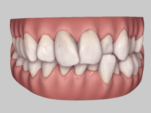 Invisalign with a Dental Extraction — Dental Smiles Takeley