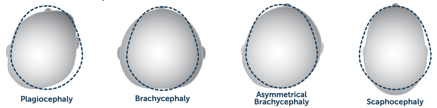 Orthotic Care Services | Helmet Program