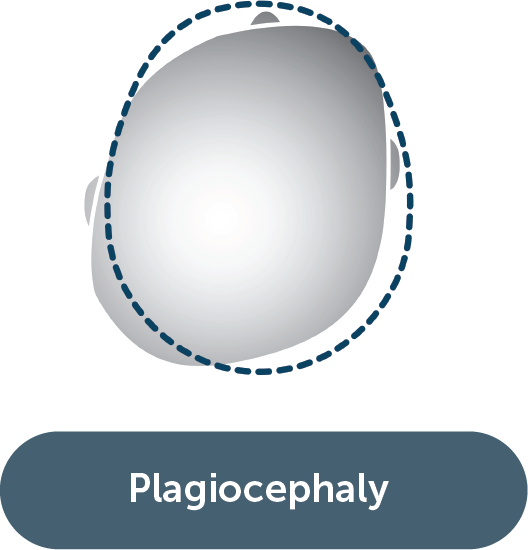 Orthotic Care Services | Helmet Program