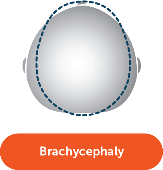 Orthotic Care Services | Helmet Program