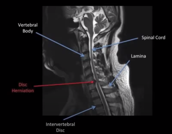 How to Read a Back MRI Report — Spine Together