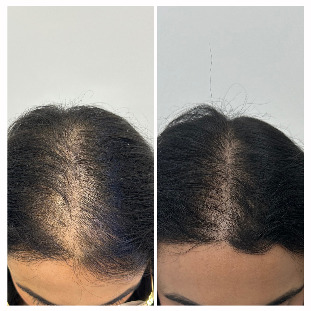 Hair Transplant — The PRP Lab.
