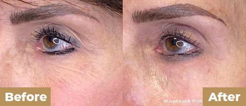 Morpheus8 Skin Tightening | RF Microneedling for Face & Body | The PRP ...