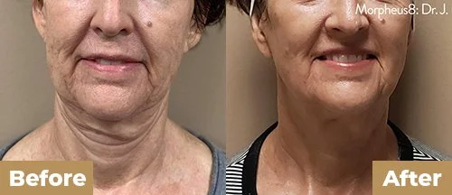 Morpheus8 Skin Tightening | RF Microneedling for Face & Body | The PRP ...
