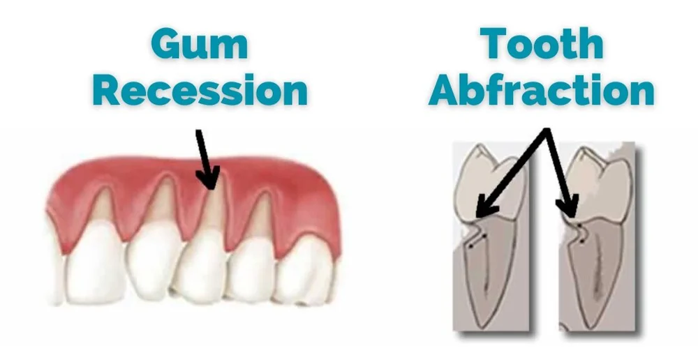 What you should know about an Abfraction — Smiles by Bergen Dental