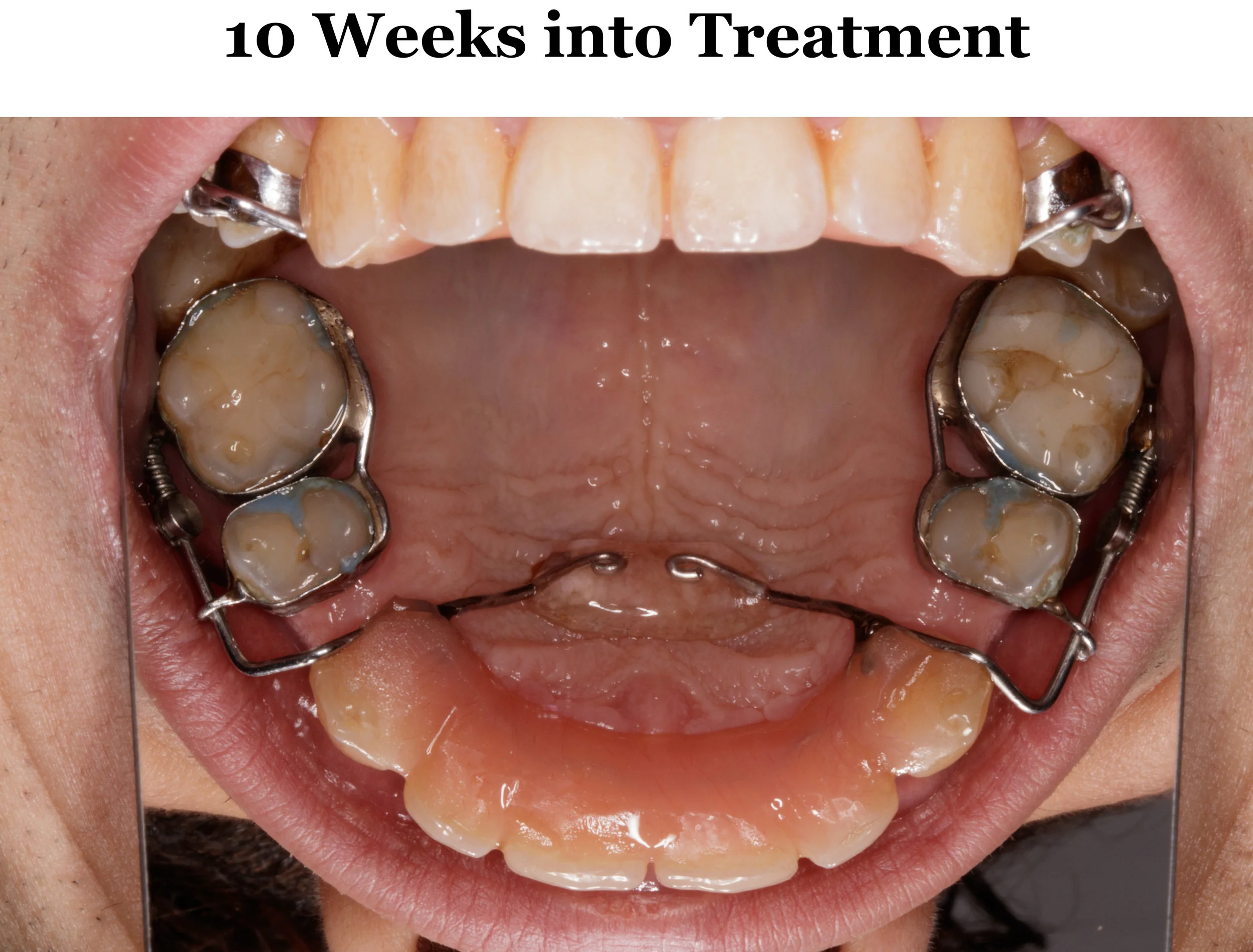 Lower Jaw Expander