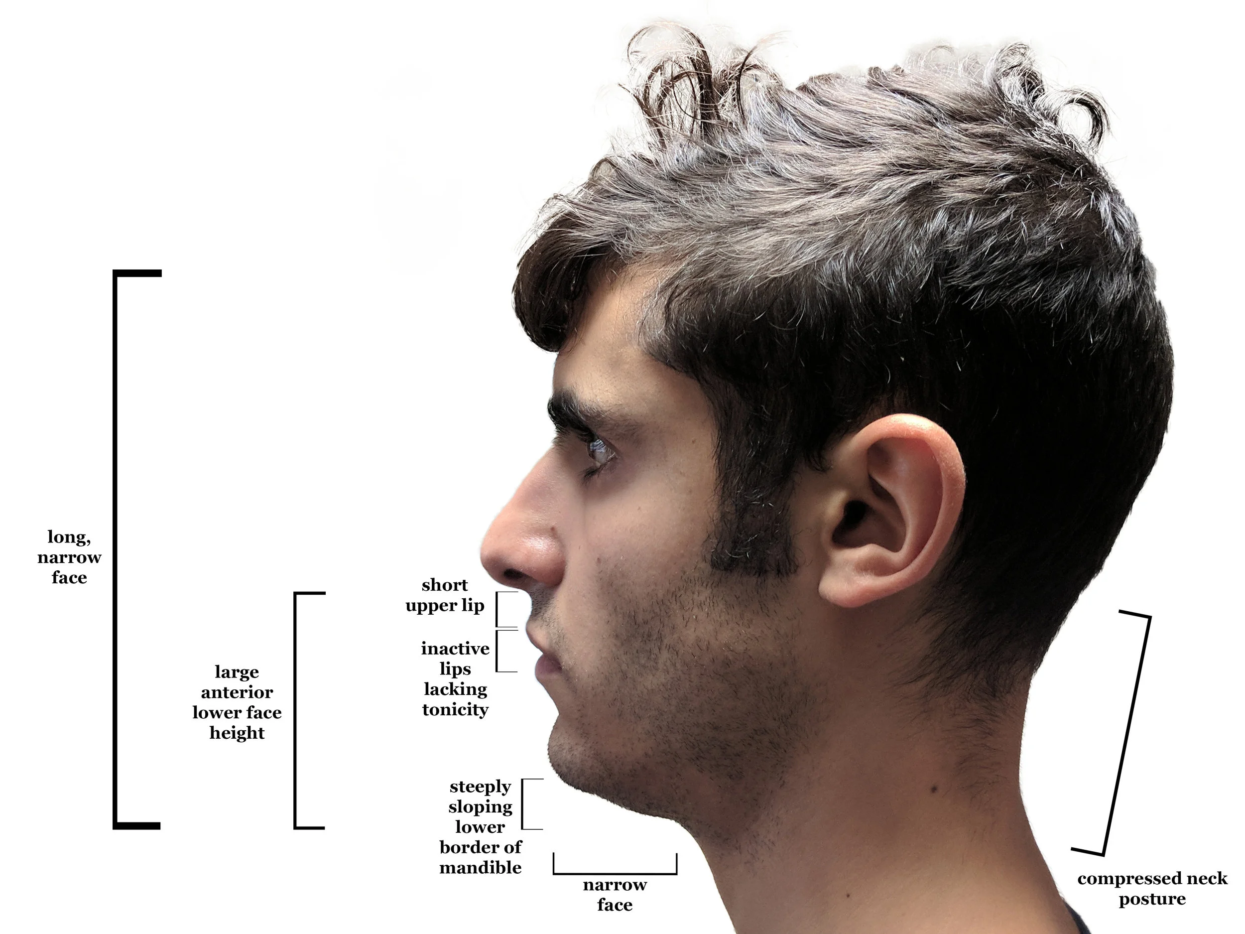 Adenoid Face Before And After