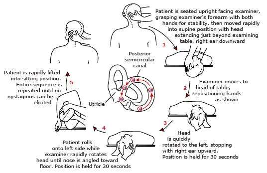 What is BPPV and How Can PT Help it? — Physical Therapy in Brooklyn ...