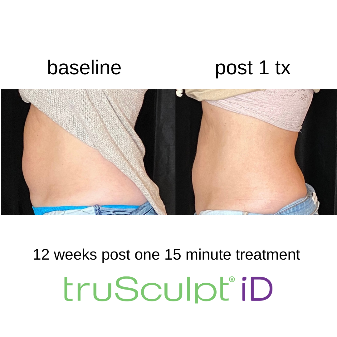 Trusculpt Id Body Sculpting — All About Massage Day Spa