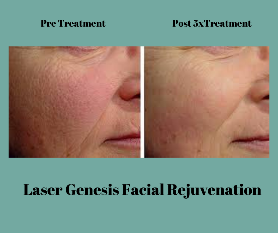 Laser Hair Removal — All About Massage Day Spa