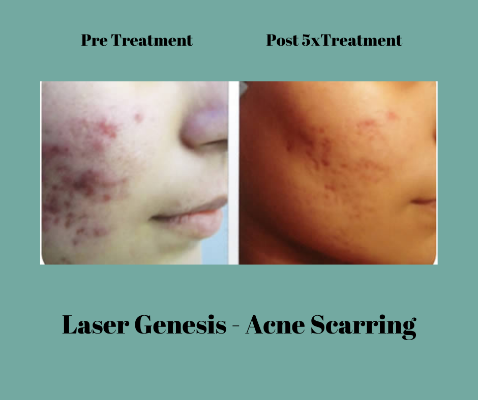 Laser Hair Removal — All About Massage Day Spa