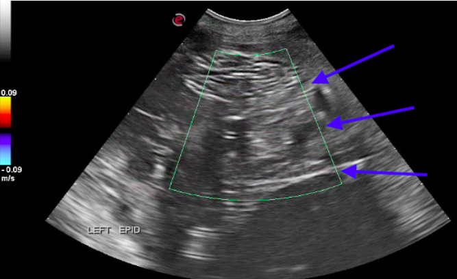 Testicular Torsion Ultrasound