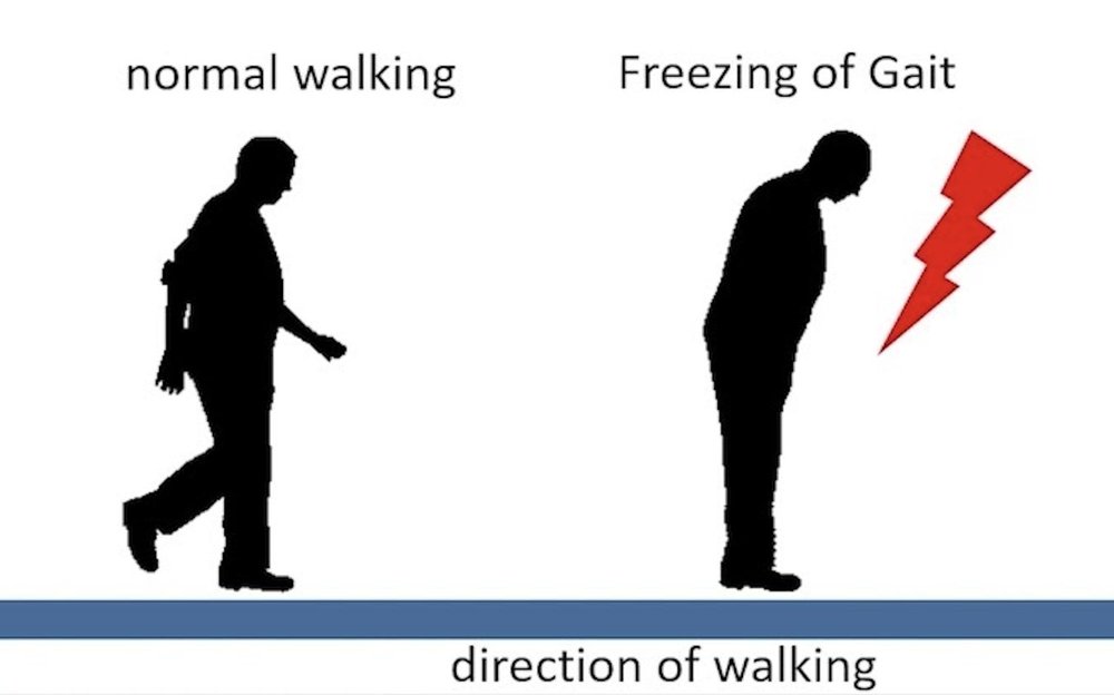 Freezing of Gait and Parkinson’s Disease: Effective Exercises to ...