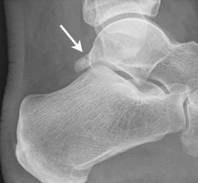 Posterior Ankle Impingement — Dynamic Physio Therapy | Naples, FL ...