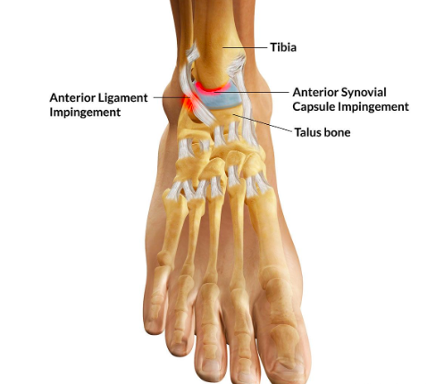 Anterior Ankle Impingement — Dynamic Physio Therapy | Naples, FL ...