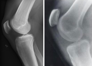 Knee Dislocation and Patella Alta — Dynamic Physio Therapy | Naples, FL ...