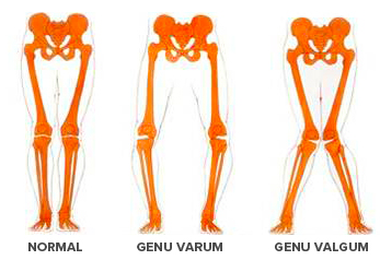 The TFL: a Pesky Little Muscle — Dynamic Physio Therapy | Naples, FL ...