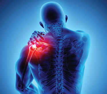 Snapping Scapula Syndrome — Dynamic Physio Therapy | Naples, FL ...