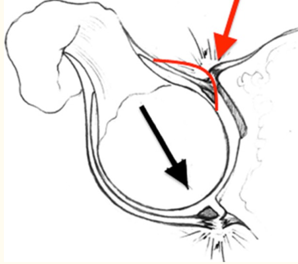 SI Joint Pain and Hip Impingement (FAI) — Dynamic Physio Therapy ...