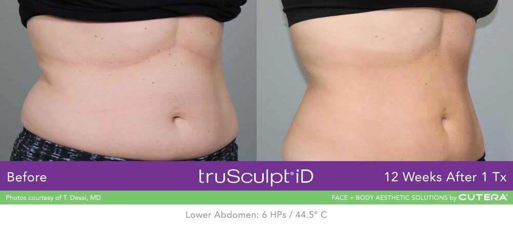 Trusculpt Id Vs Coolsculpting Houston Artavi Med Spa — Artavi Med Spa