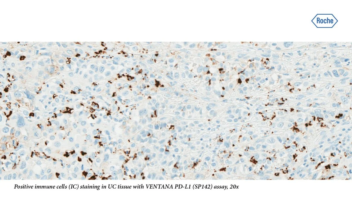 Protean Launches PD-L1 (SP142) Assay for Breast Cancer — Protean BioDx