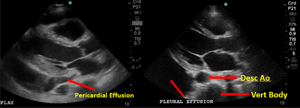 Pericardial vs Pleural Effusion — Temple Point-of-Care Ultrasound