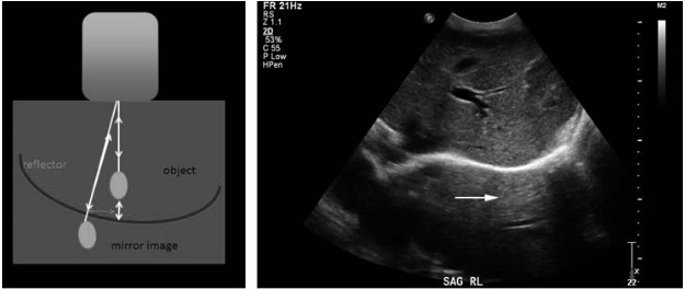 A Review Of Common US Artifacts Temple Emergency Ultrasound a-review-of-common-us-artifacts-temple-emergency-ultrasound