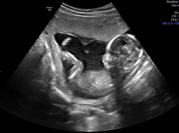 Its A Girl Ultrasound 16 Weeks