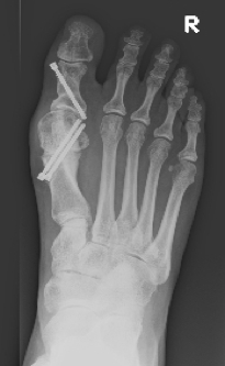 Bunionectomy X Ray