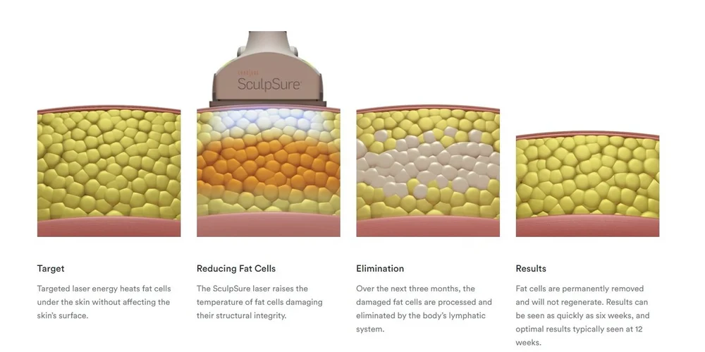 Sculpsure — CRYO ENERGY