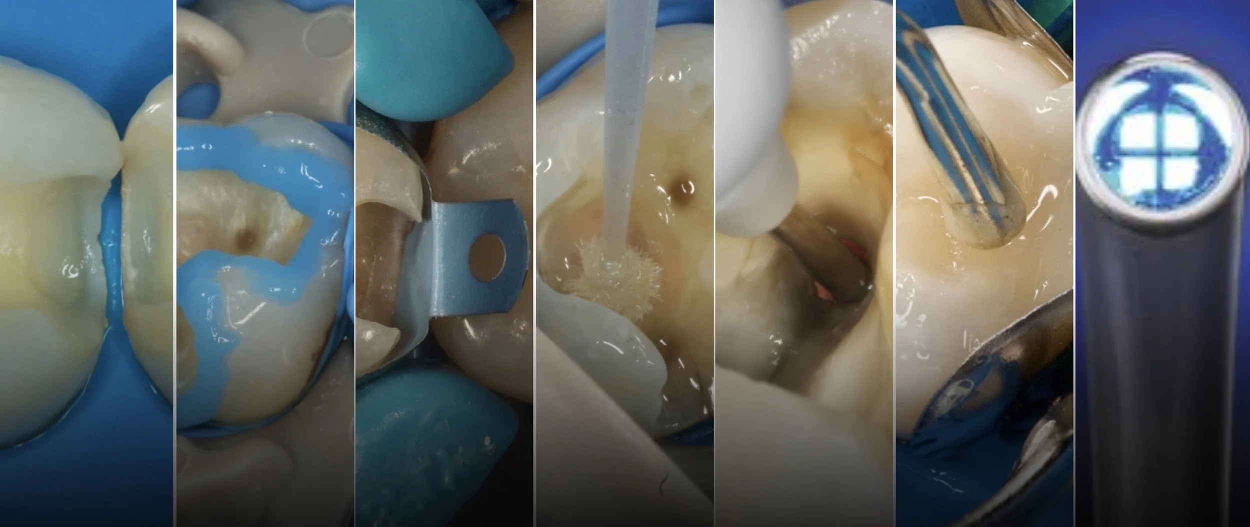 POSTERIOR COMPOSITES COURSE — DENTER