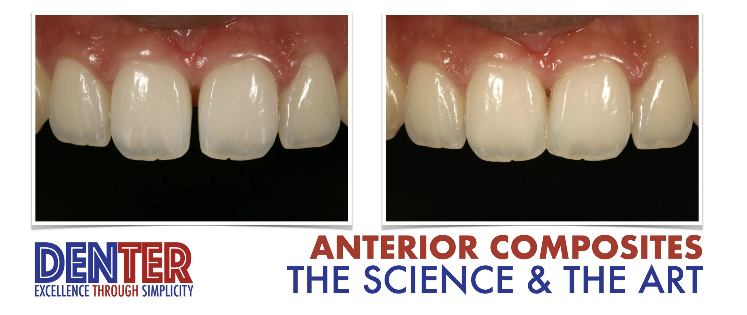 ANTERIOR COMPOSITE COURSE — DENTER
